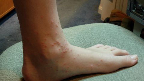 Chiggers | Panhandle Outdoors